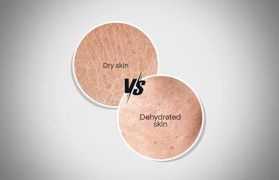 Dry skin vs Dehydrated skin: What are the Differences